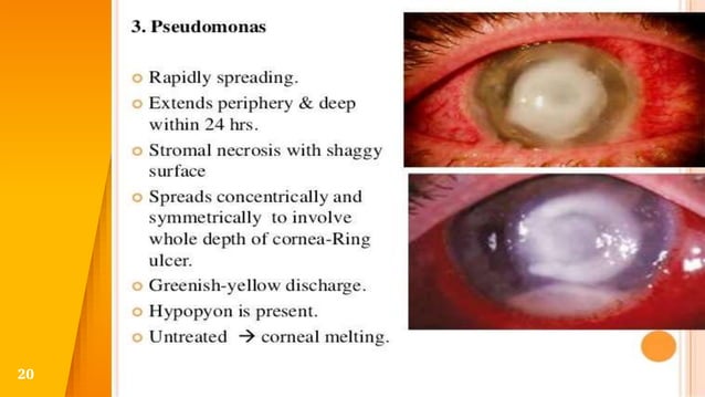CORNEAL ULCER ,DR M SAQUIB , OPHTHALMOLOGY | PPT