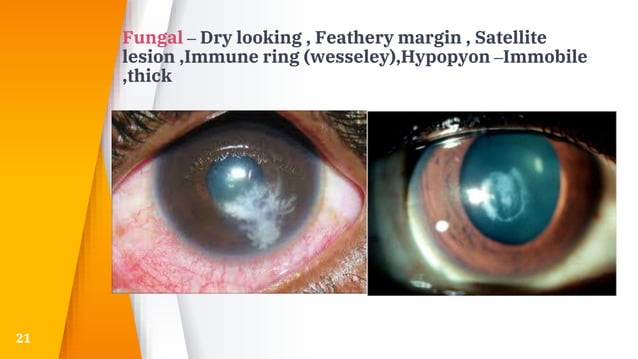 CORNEAL ULCER ,DR M SAQUIB , OPHTHALMOLOGY | PPT