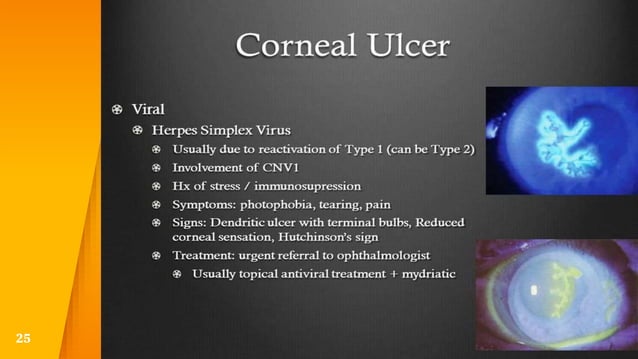 CORNEAL ULCER ,DR M SAQUIB , OPHTHALMOLOGY | PPT