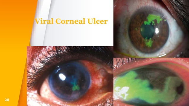 CORNEAL ULCER ,DR M SAQUIB , OPHTHALMOLOGY | PPT