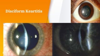 CORNEAL ULCER ,DR M SAQUIB , OPHTHALMOLOGY | PPTX