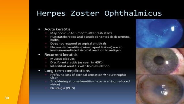 CORNEAL ULCER ,DR M SAQUIB , OPHTHALMOLOGY | PPT