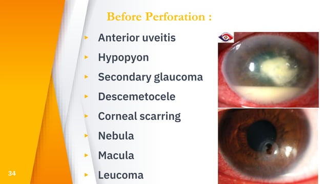 CORNEAL ULCER ,DR M SAQUIB , OPHTHALMOLOGY | PPT
