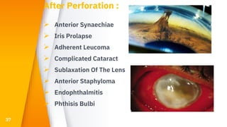 CORNEAL ULCER ,DR M SAQUIB , OPHTHALMOLOGY | PPTX