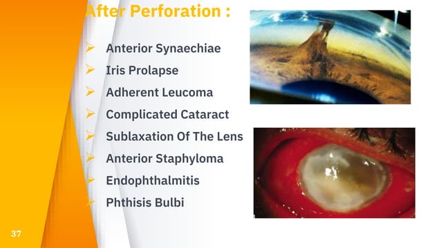 CORNEAL ULCER ,DR M SAQUIB , OPHTHALMOLOGY | PPT