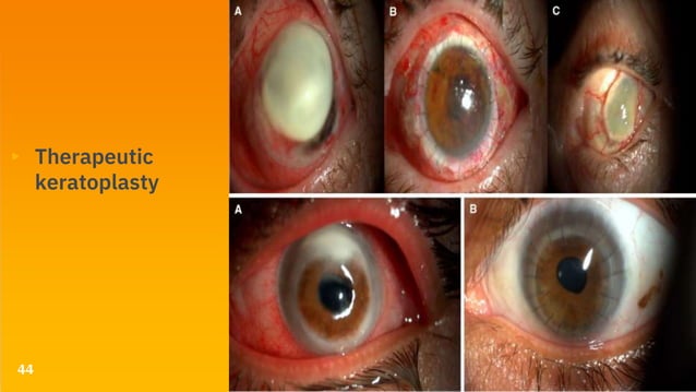 CORNEAL ULCER ,DR M SAQUIB , OPHTHALMOLOGY | PPT