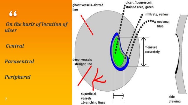 Corneal Ulcer Dr M Saquib Ophthalmology Ppt