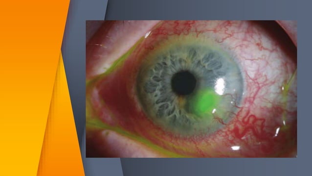CORNEAL ULCER ,DR M SAQUIB , OPHTHALMOLOGY | PPT