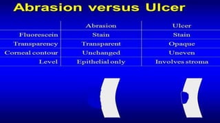 Corneal Abrasion Vs Ulcer