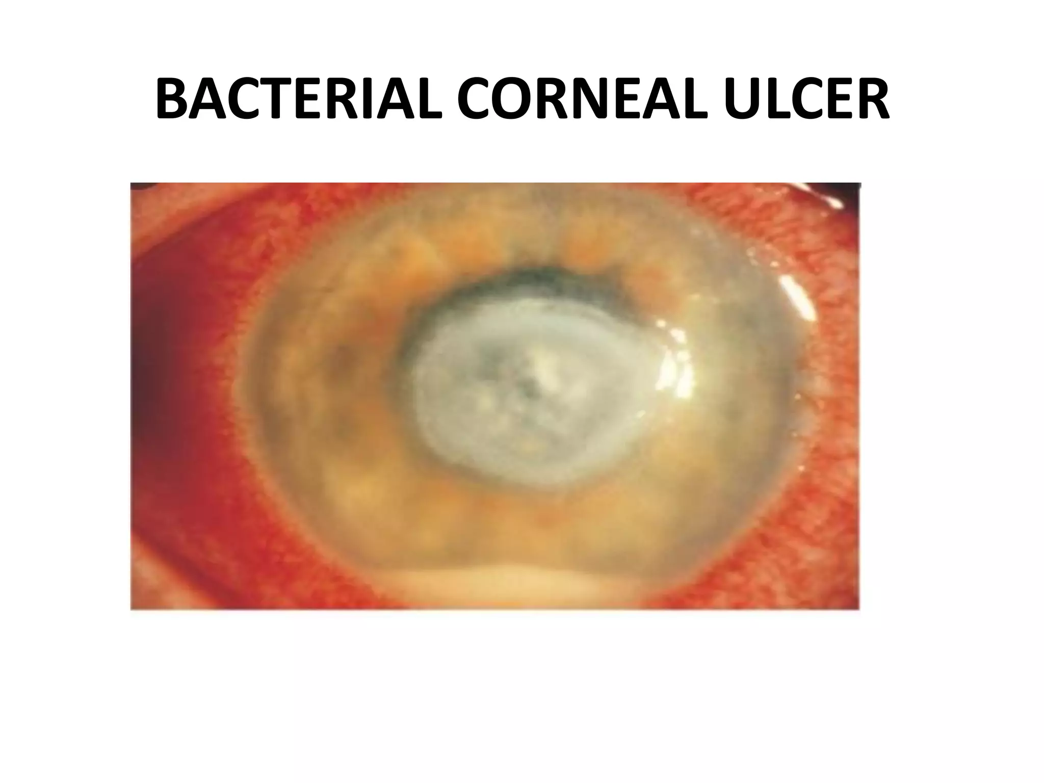 Corneal Ulcer.pdf