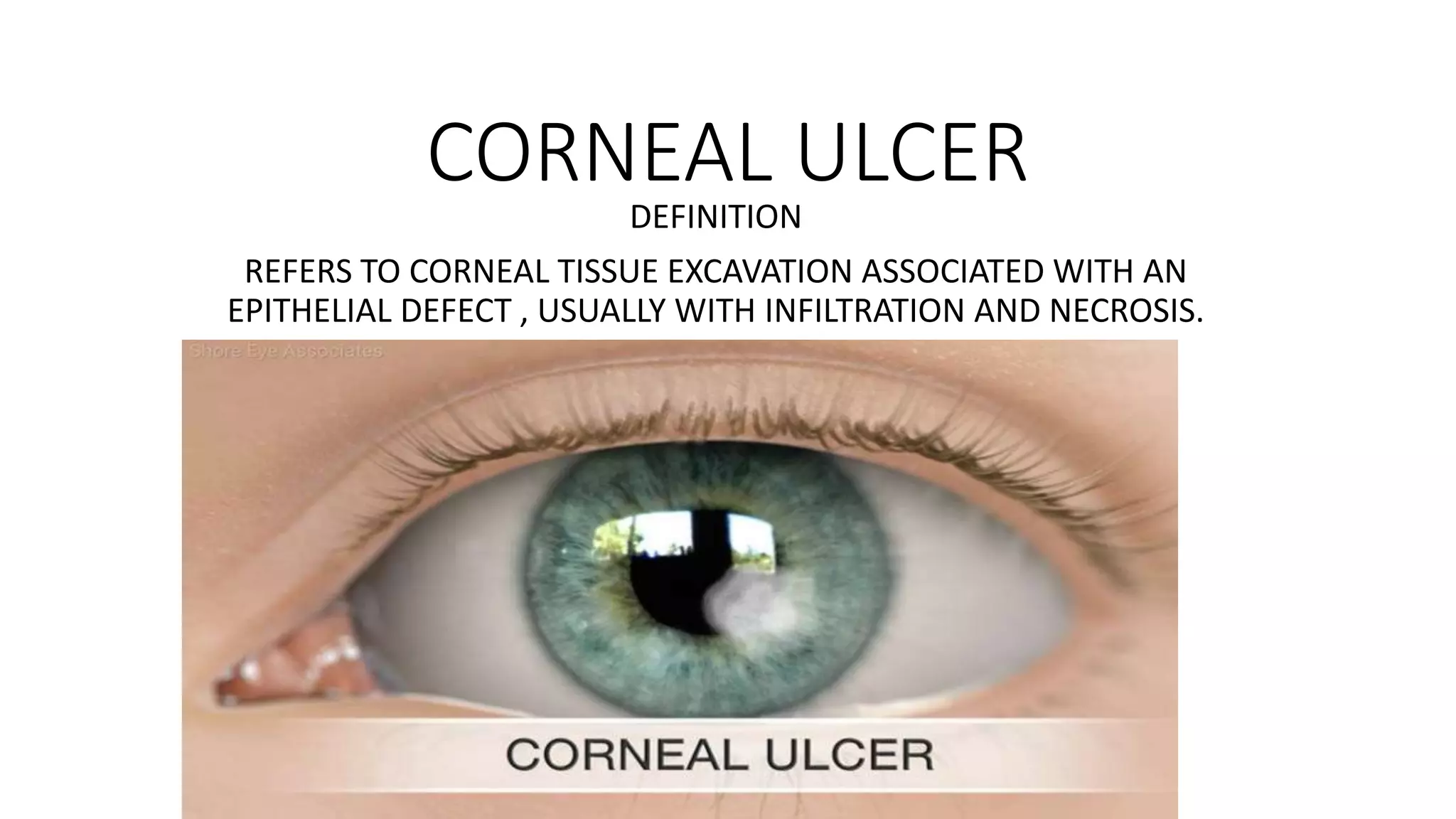 CORNEAL ULCER.pptx