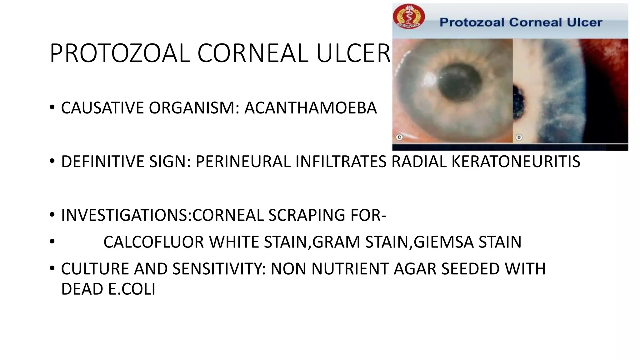 CORNEAL ULCER.pptx