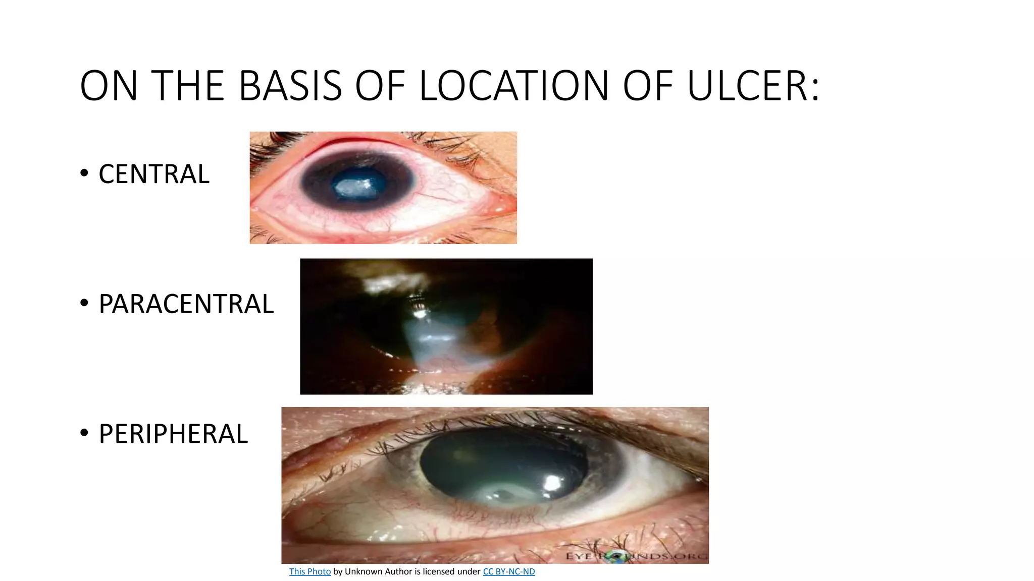 CORNEAL ULCER.pptx