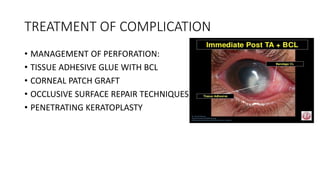 CORNEAL ULCER.pptx