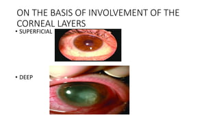 CORNEAL ULCER.pptx