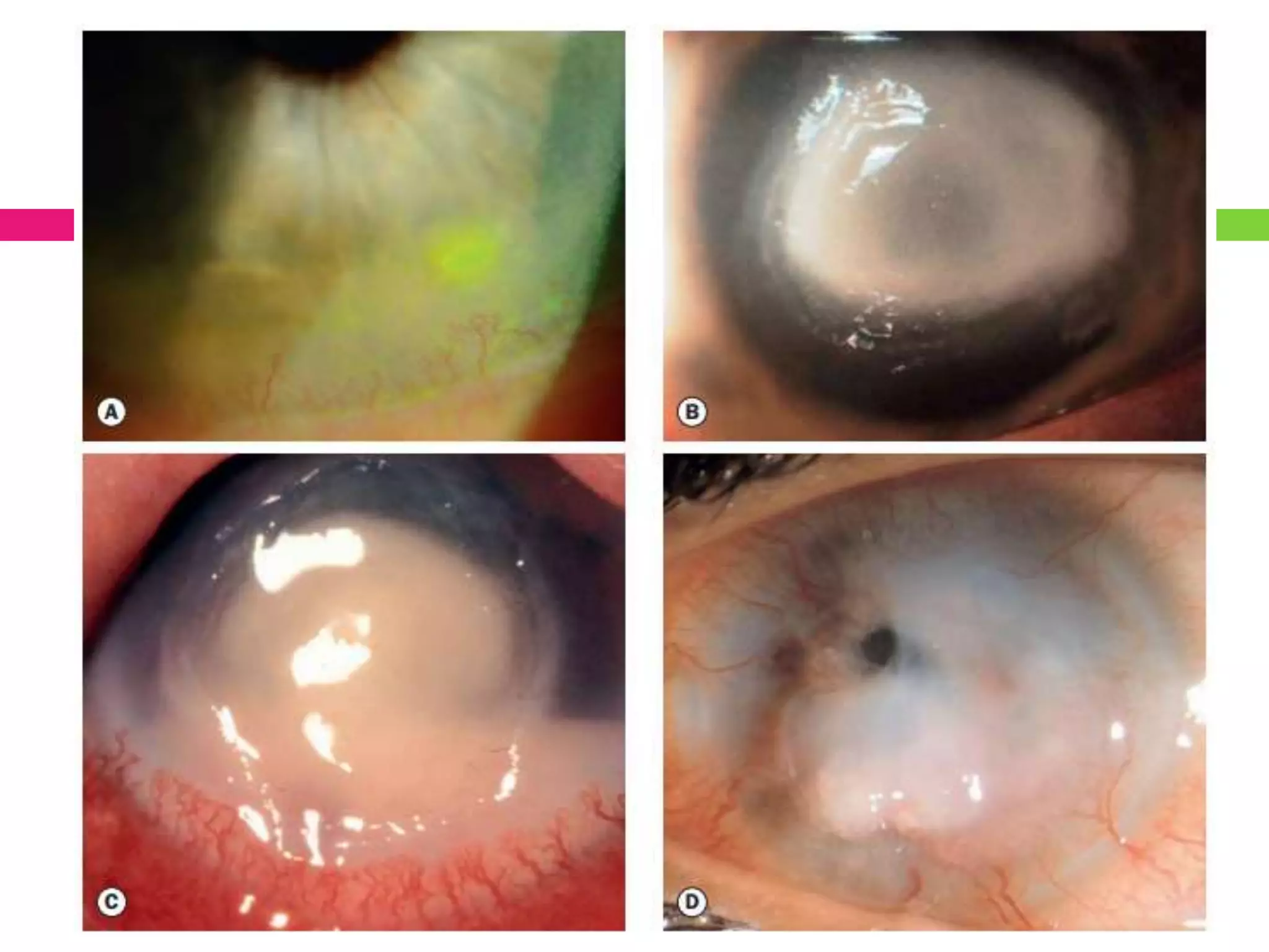 corneal ulcer.pptx