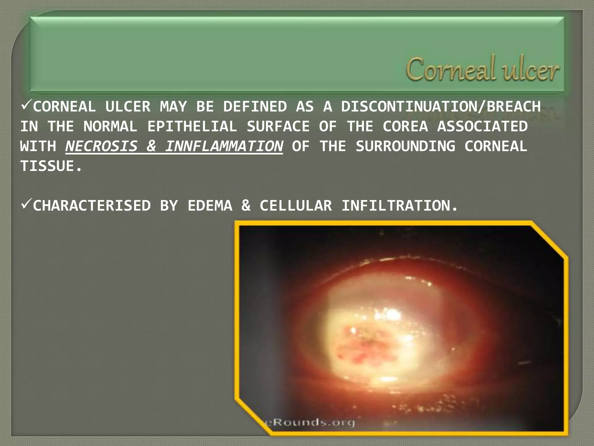 Corneal Ulcer.pptx