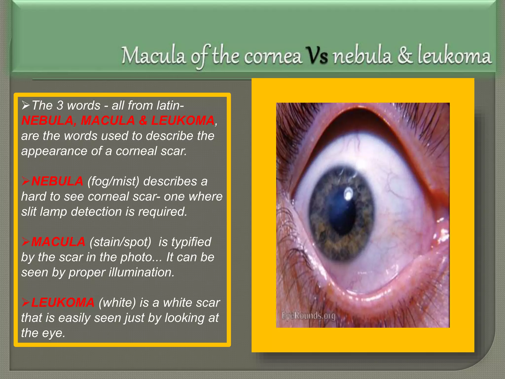 Corneal Ulcer.pptx