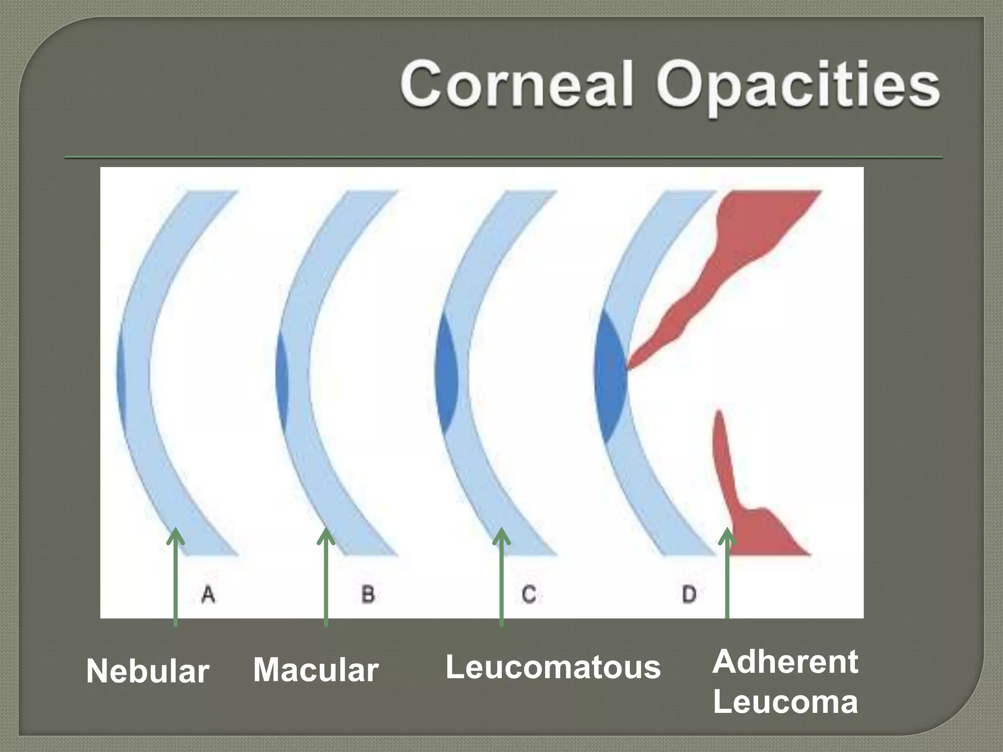 Corneal Ulcer.pptx