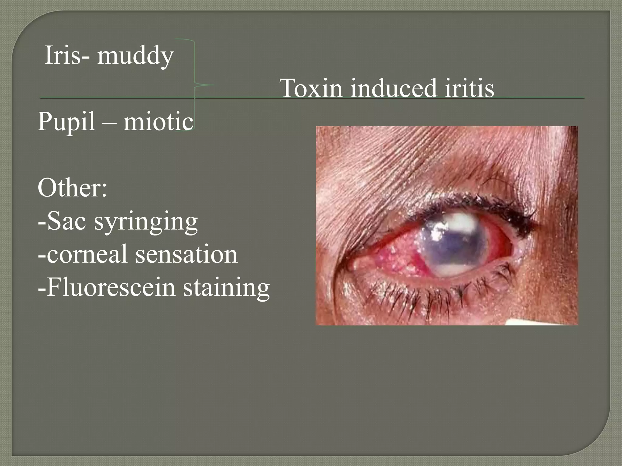 Corneal Ulcer.pptx