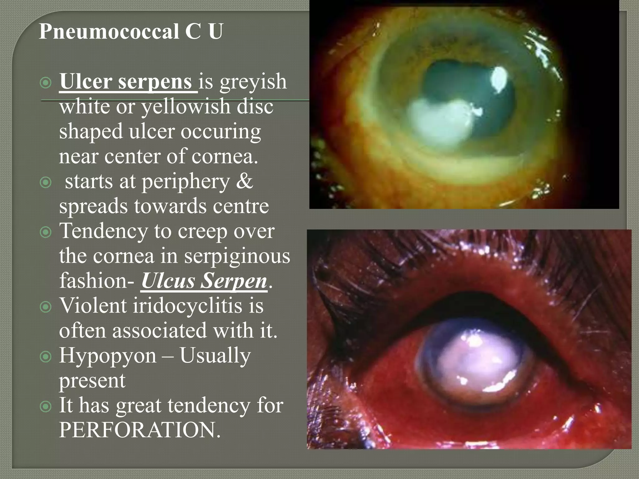 Corneal Ulcer.pptx