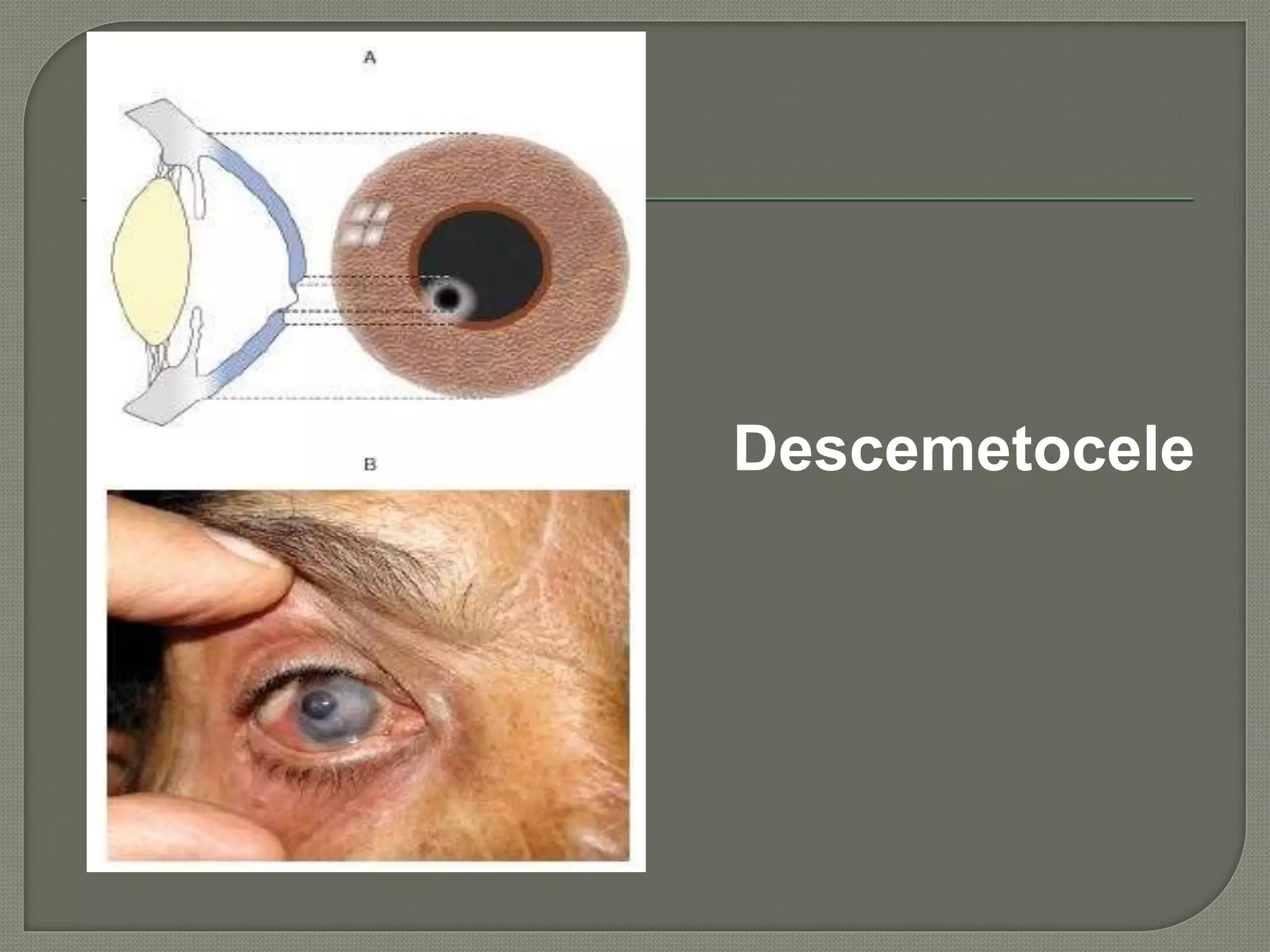 Corneal Ulcer.pptx