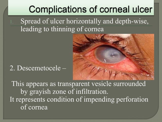 Corneal Ulcer.pptx | Eye and Vision Conditions | Diseases and Conditions