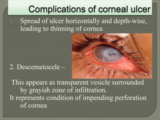 Corneal Ulcer.pptx