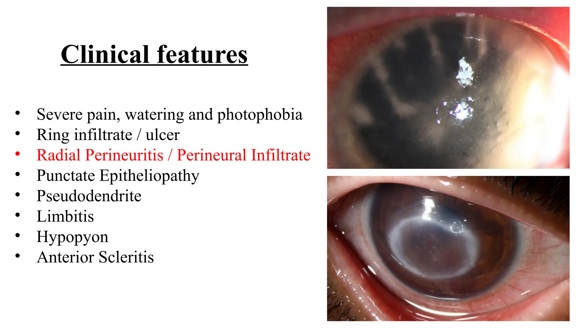 Corneal Ulcer (bacterial, fungal, acanthamoeba).pptx