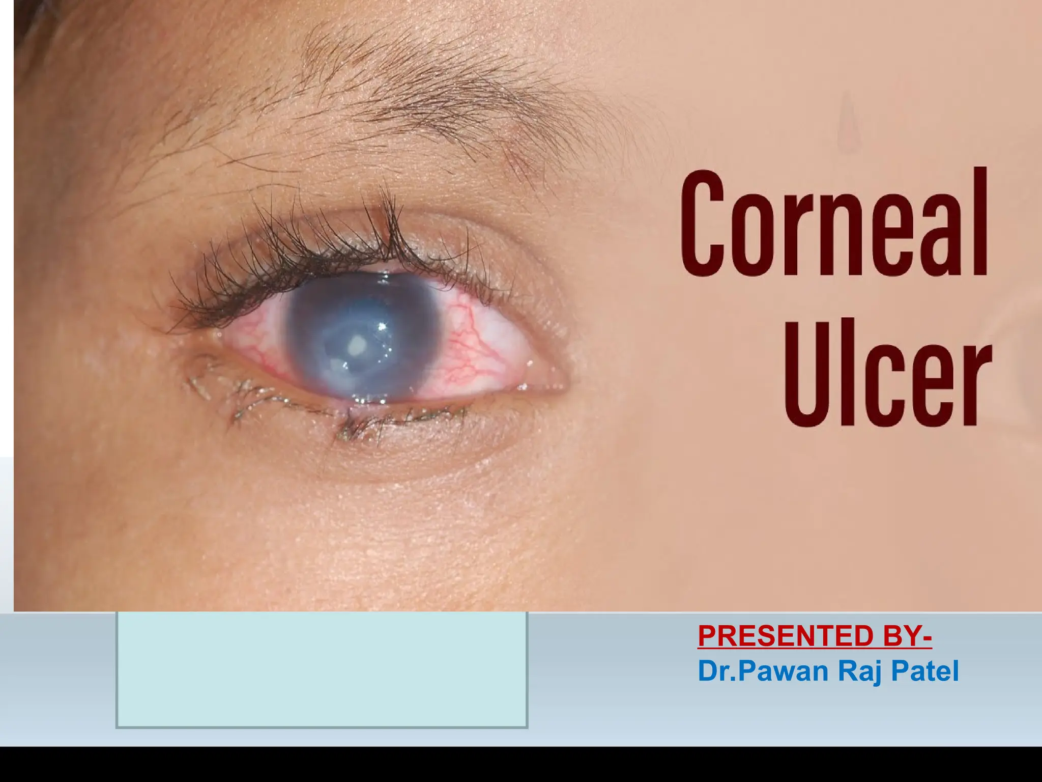 corneal ulcer.ppt very important topicpics | PPT