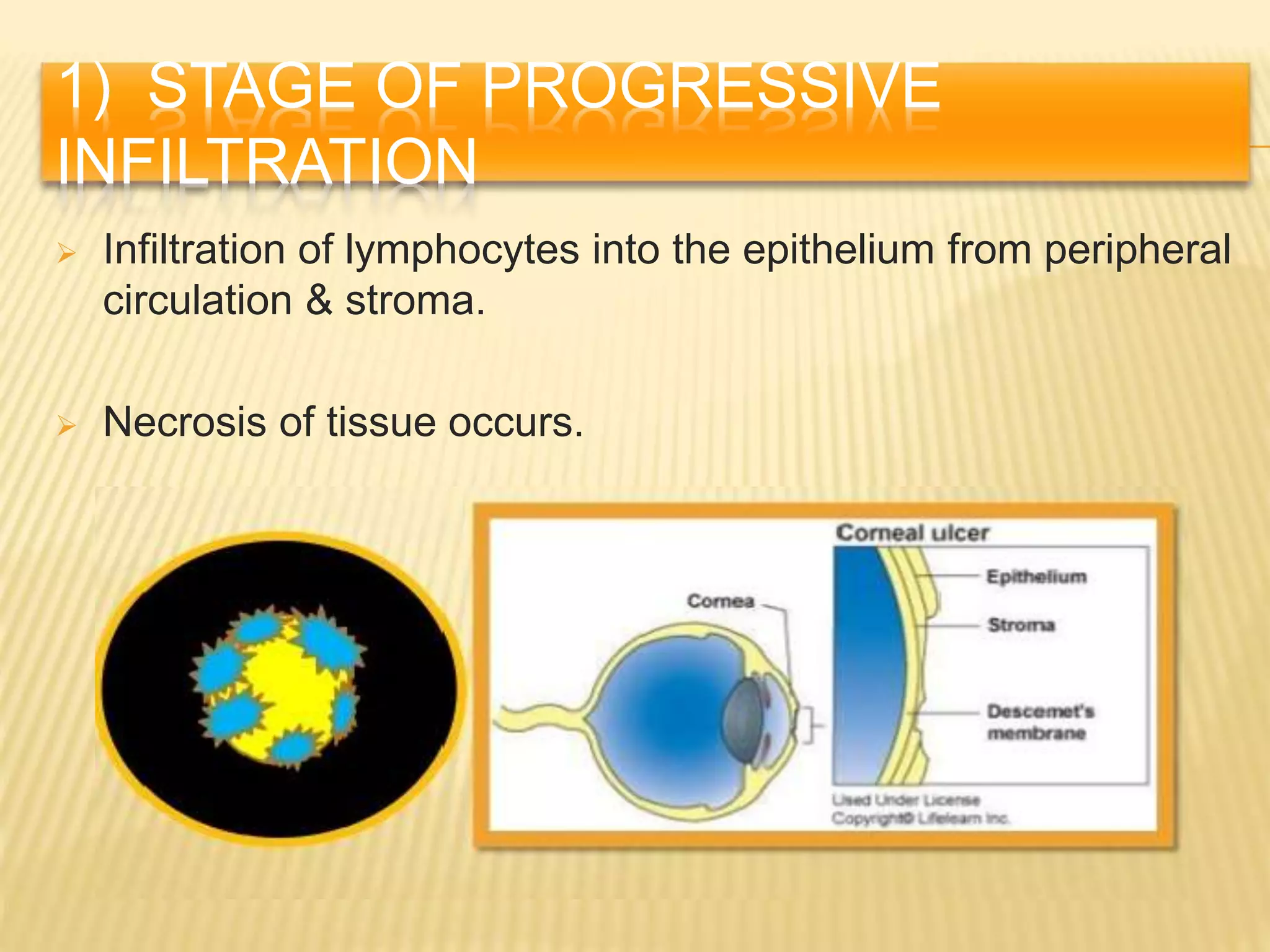 Corneal ulcer bact & fungal n | PPT