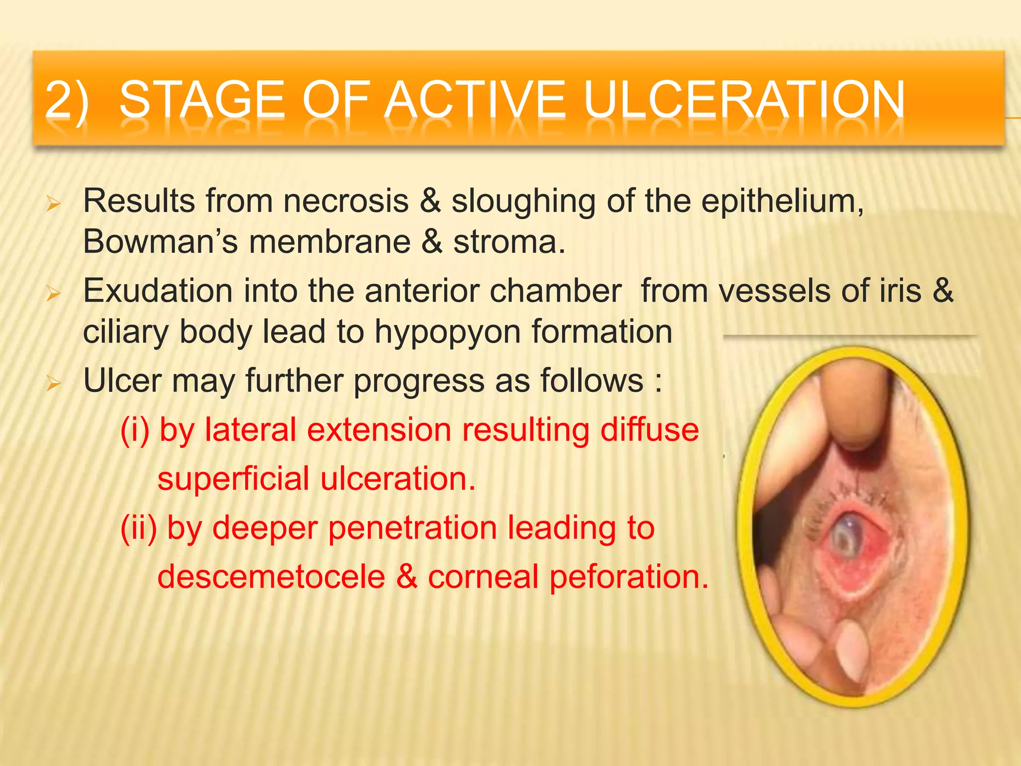 Corneal ulcer bact & fungal n | PPTX