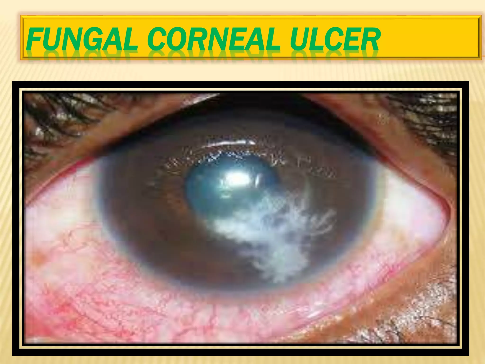 Corneal ulcer bact & fungal n | PPT