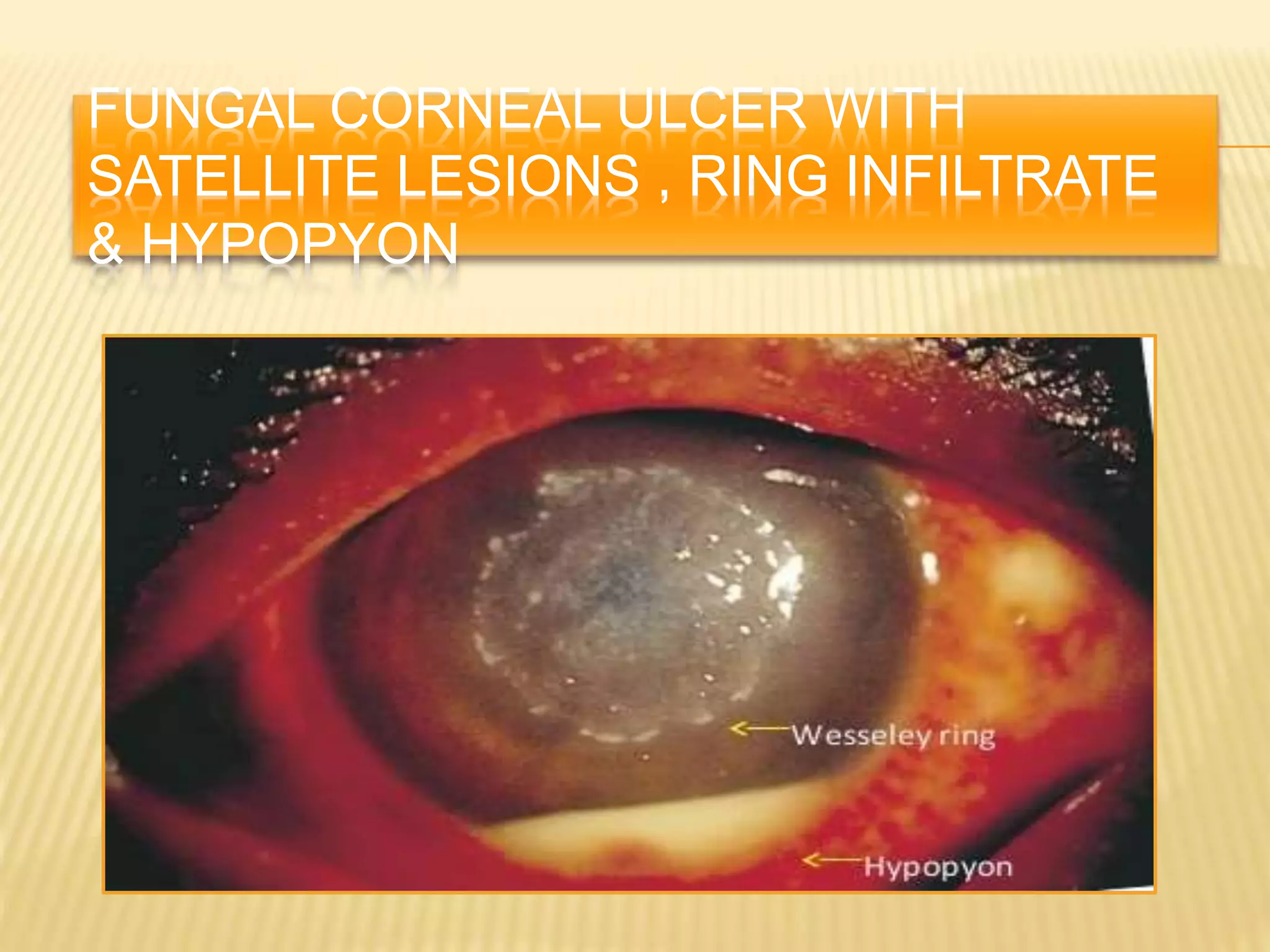 Corneal ulcer bact & fungal n | PPT