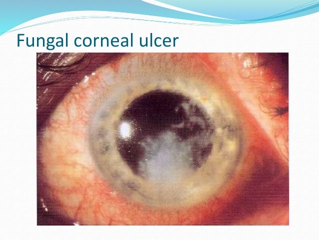 Corneal ulcer(bactrial,fungal) 25.02.16, dr.k.n.jha