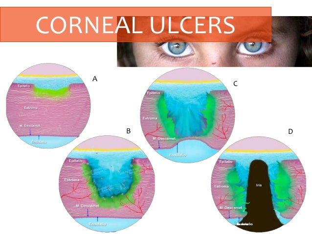 Corneal ulcers