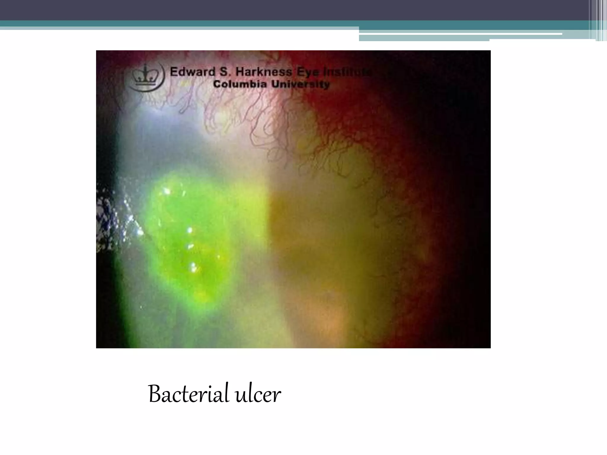 Corneal ulcers | PPTX