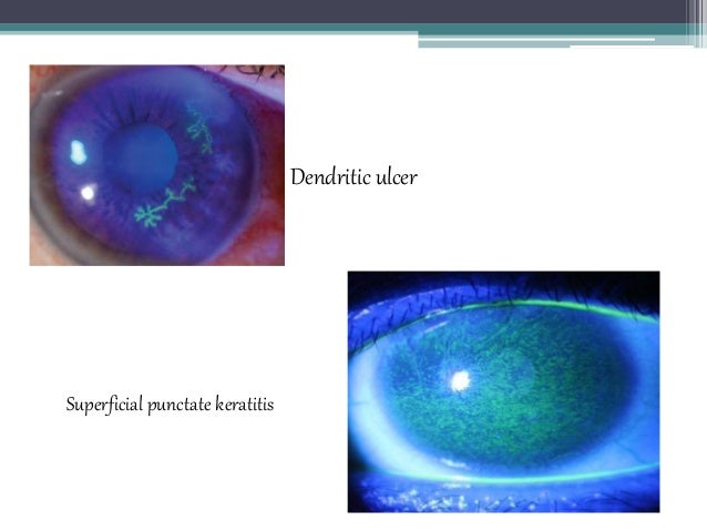 Corneal ulcers