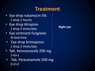 Corneal ulcer short case | PPTX