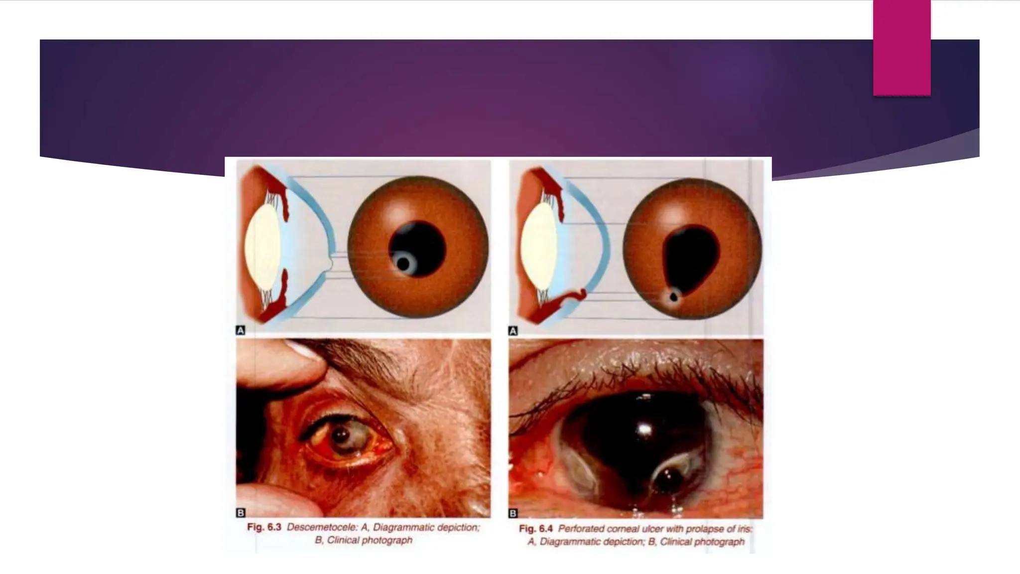 Corneal Ulcer Types And Clinical Presentation Ameena C 1 Pptx