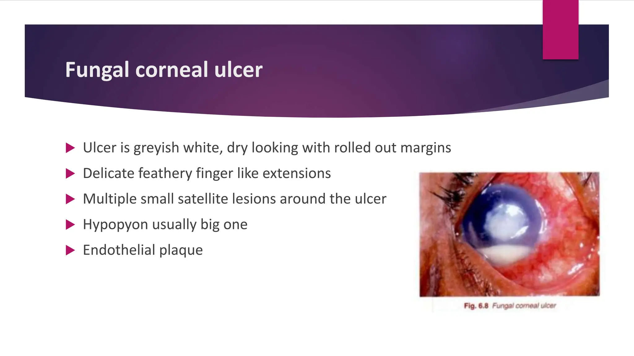 CORNEAL ULCER types and clinical presentation Ameena C (1).pptx