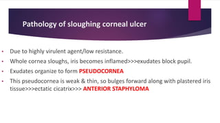 CORNEAL ULCER types and clinical presentation Ameena C (1).pptx