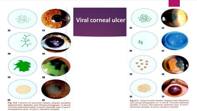CORNEAL ULCER types and clinical presentation Ameena C (1).pptx ...