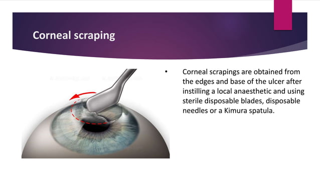 CORNEAL ULCER types and clinical presentation Ameena C (1).pptx ...
