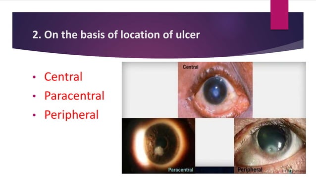 CORNEAL ULCER types and clinical presentation Ameena C (1).pptx ...
