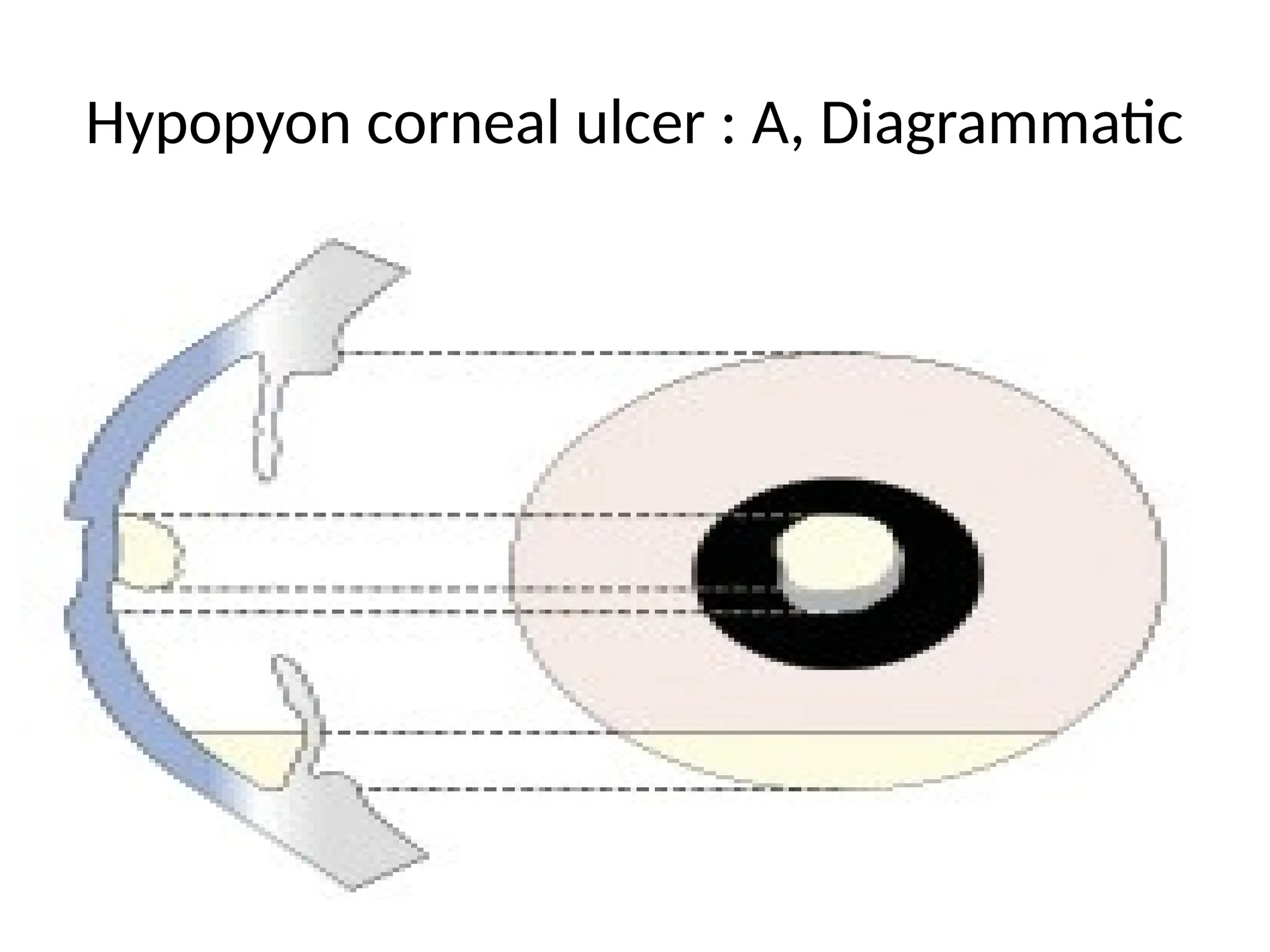 corneal ulcer (ulcerative keratitis).pptx