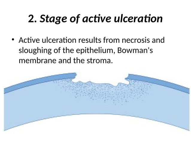 Corneal Ulcer Ulcerative Keratitis Pptx