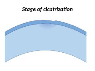 corneal ulcer (ulcerative keratitis).pptx