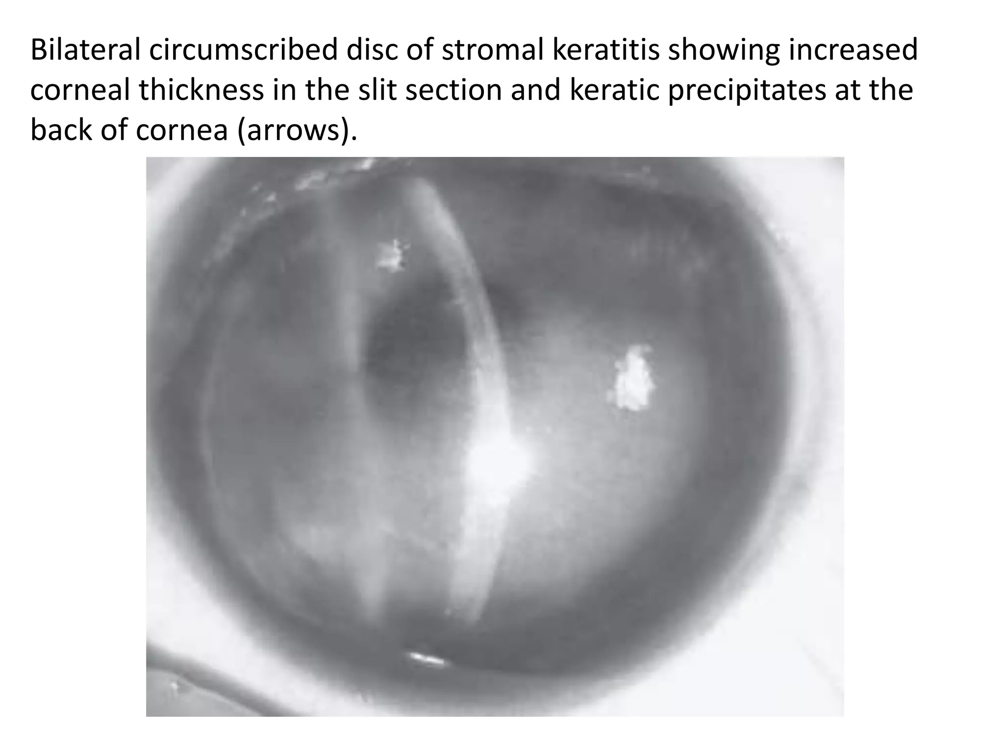 Cornea -immune mediated disorders | PPTX