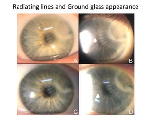 Cornea -immune mediated disorders | PPTX